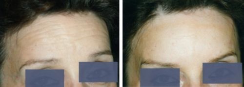 Les injections de Botox ou toxine botulique en esthétique | AFME