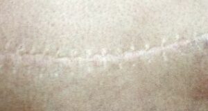 Le traitement des cicatrices par laser médical | AFME