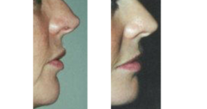 Se refaire le nez sans chirurgie, par injections correctrices